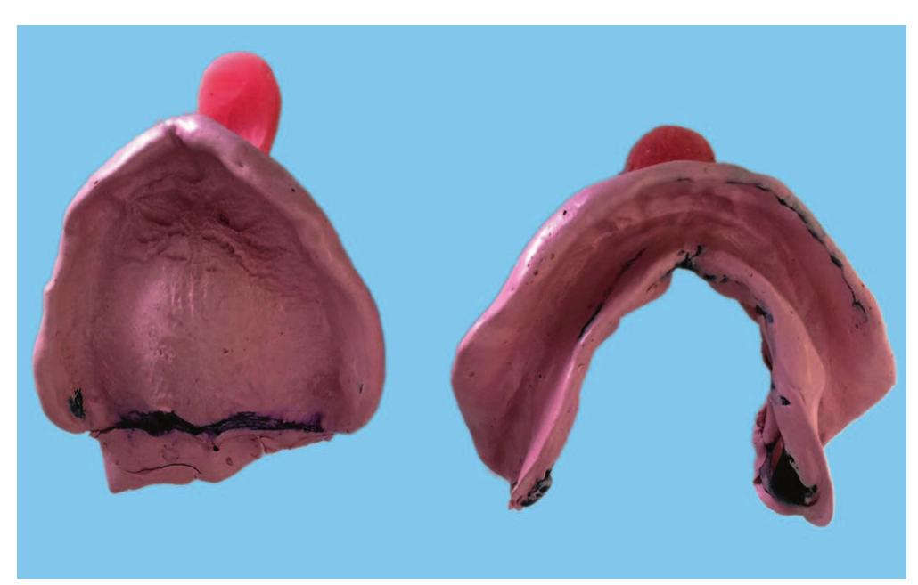 Maxillary and mandibular definitive impressions.