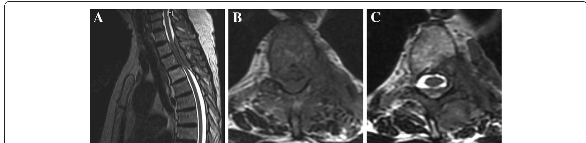 Figure 1 - from Primary epidural lymphocyte-depleted