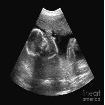 Ultrasound scan of fetus inside female body [30] the us
