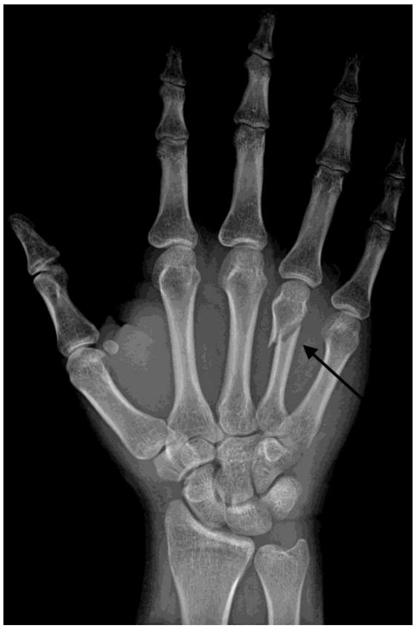 Right hand x-ray showing fracture at the neck of fourth