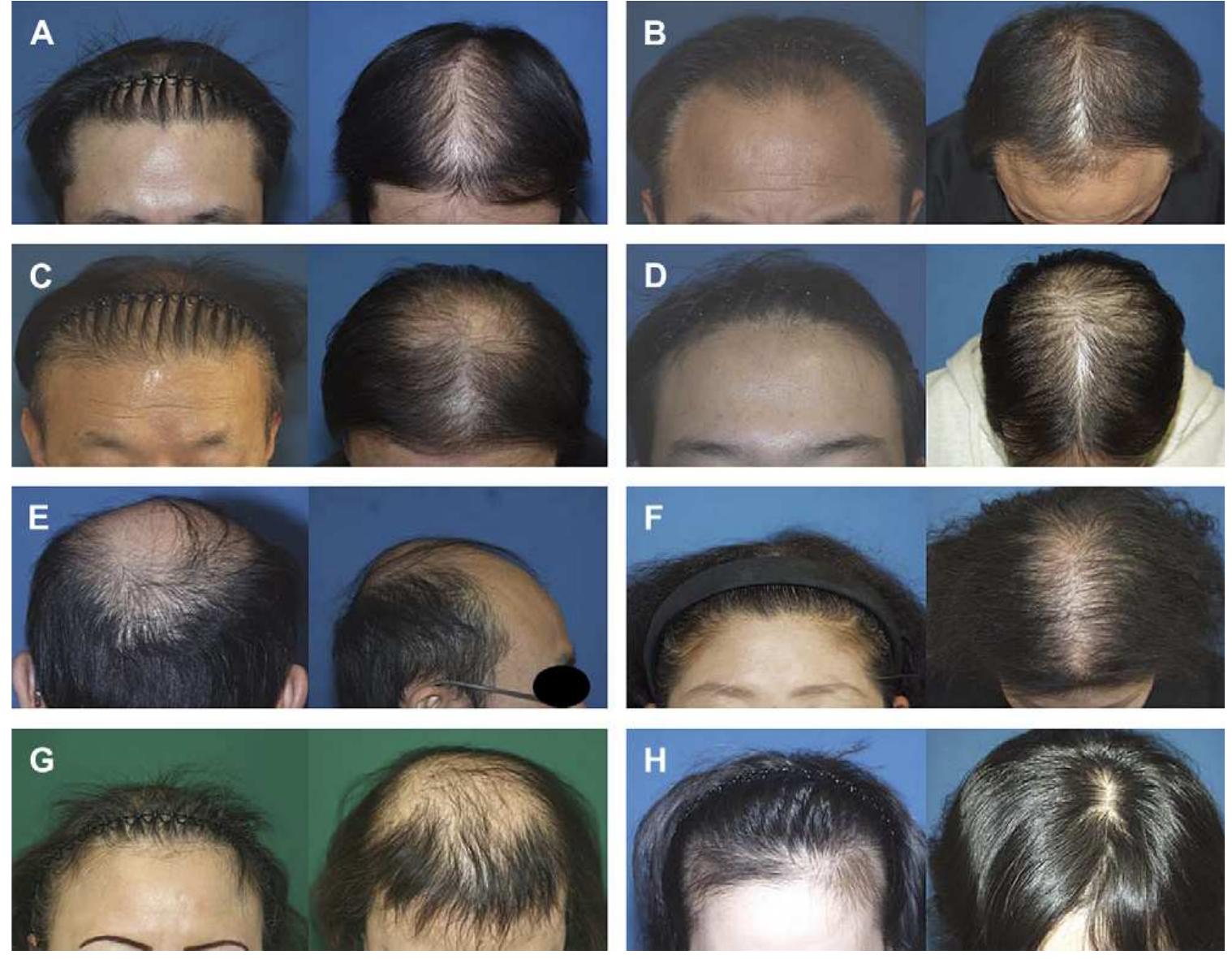 Examples of basp classification of pattern hair loss. a, a