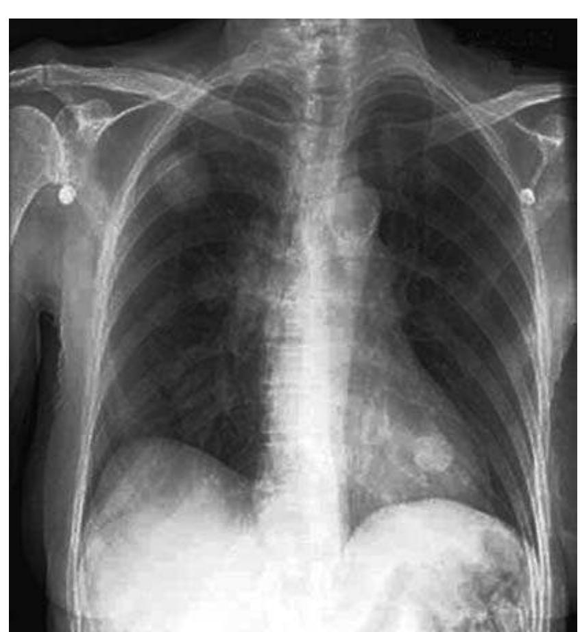 Example of mobile chest radiograph demonstrating metastatic