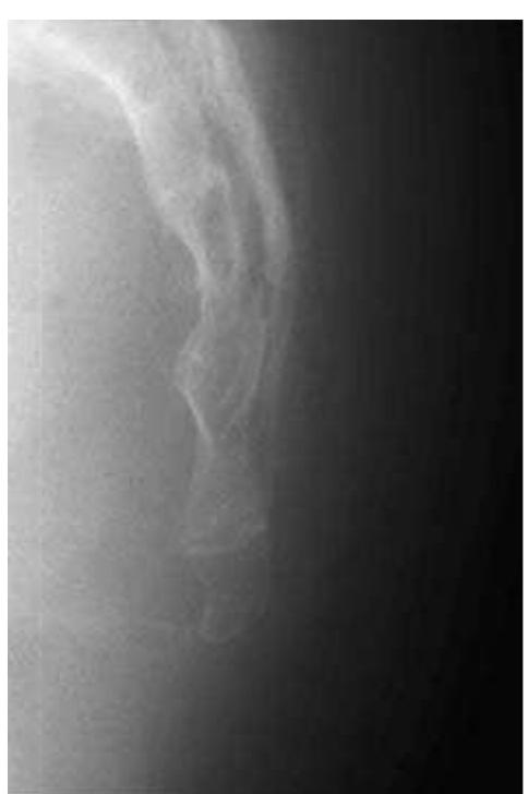 Example of lateral coccyx radiograph