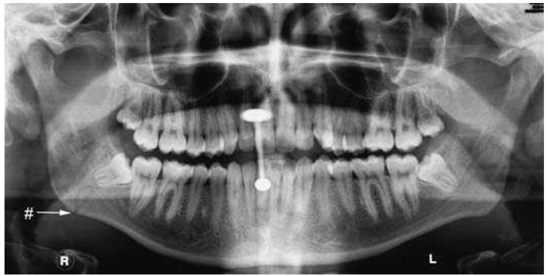 Opg demonstrating a mandibular fracture (#) and ‘tongue