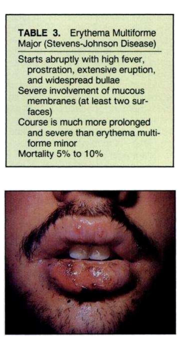 Blisters, crusting, and swelling of lips in patient with