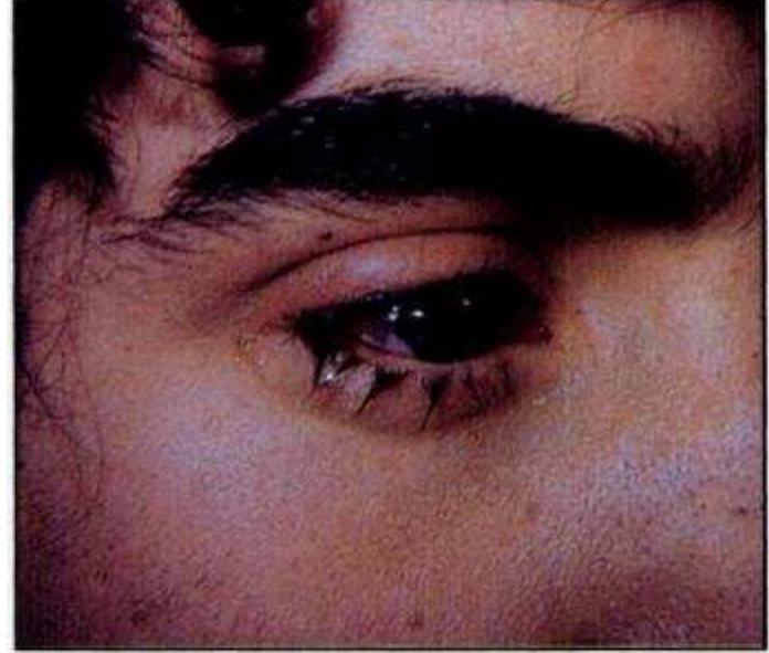 Ocular lesions in erythema multiforme major (stevens-johnson