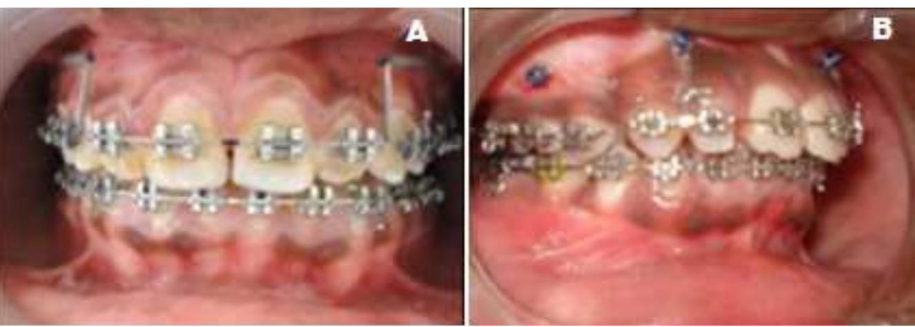 (a): intrusion of anterior segment using intrusion utility