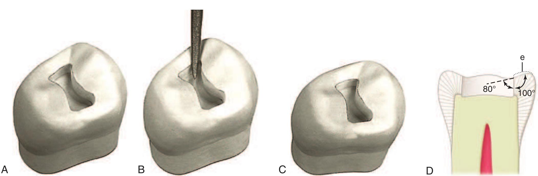 7 enameloplasty. a, developmental defect at terminal end of