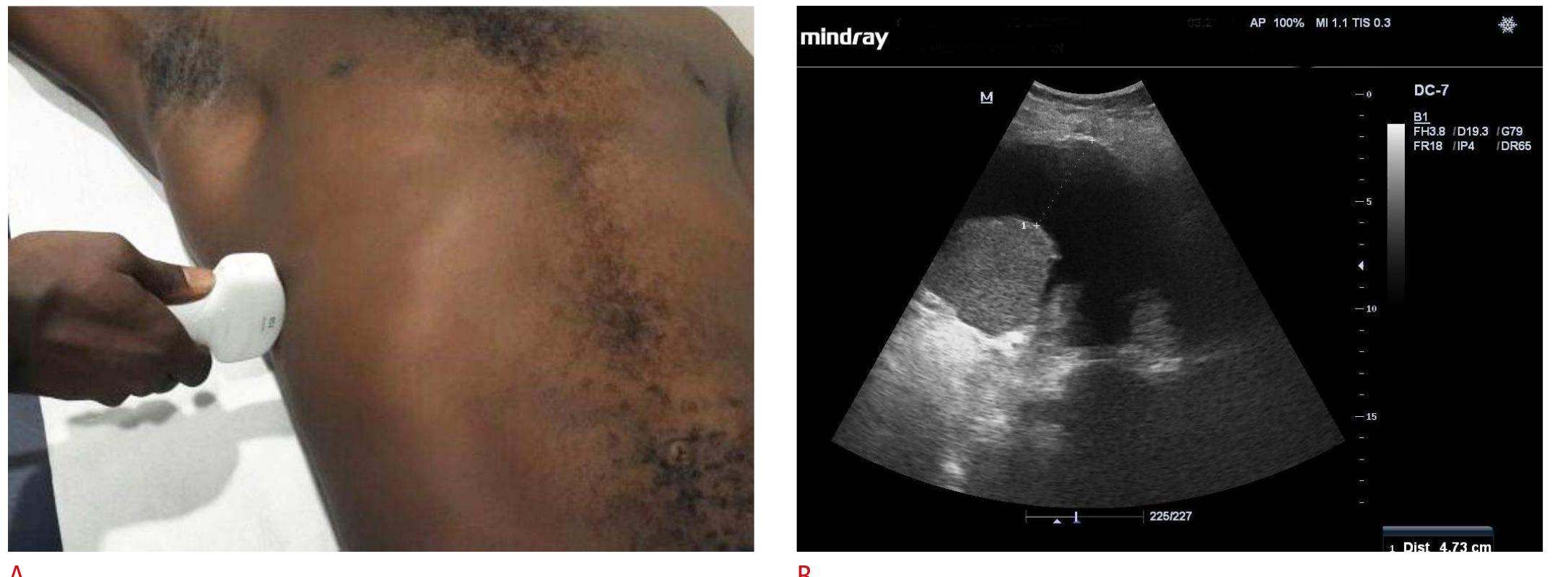 Figure 1 - from Ultrasonographic quantification of pleural