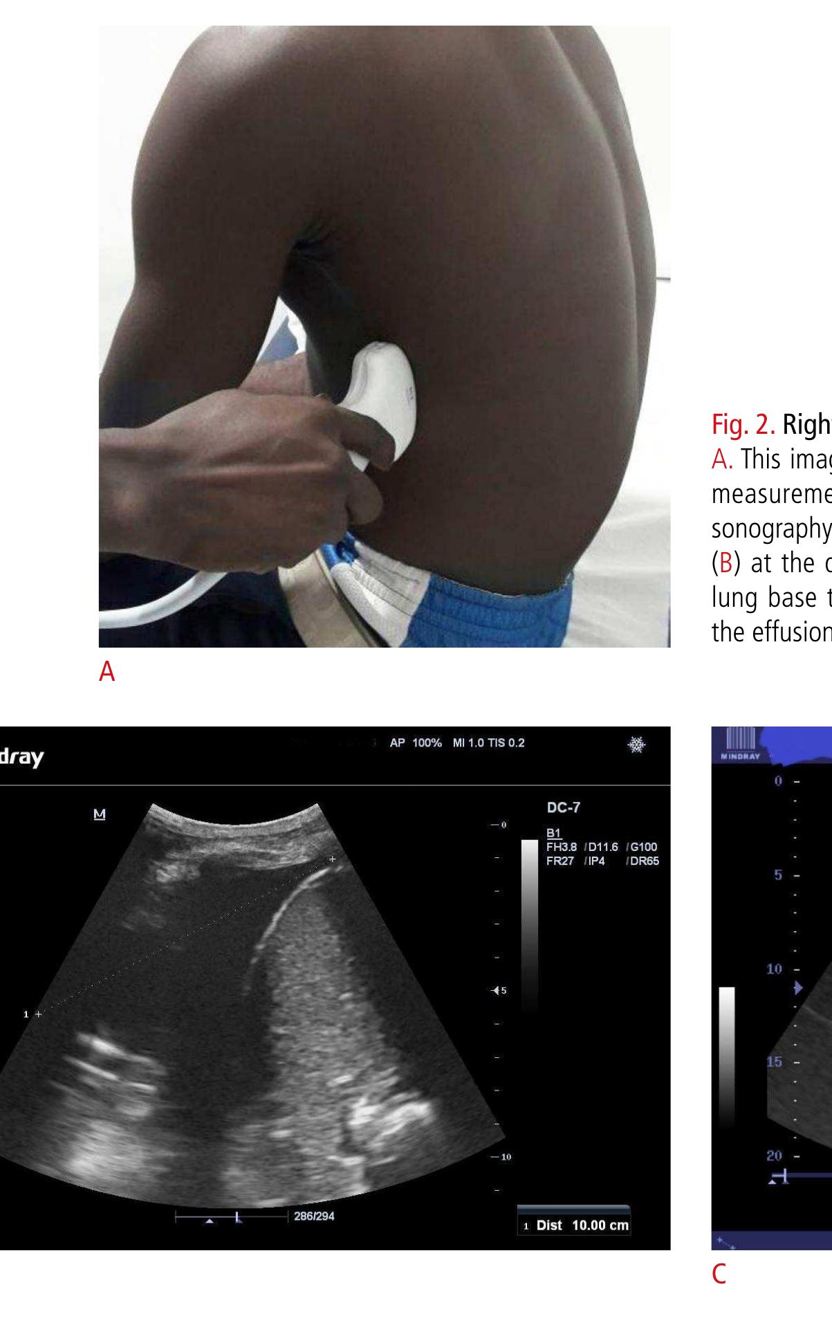 Thereafter, patients sat in a fully erect position (no