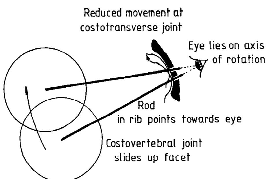 Diagram showing projection of a rod inserted in neck of 1st