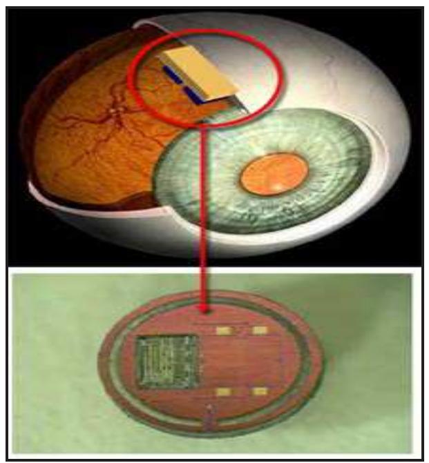 Implanted chip