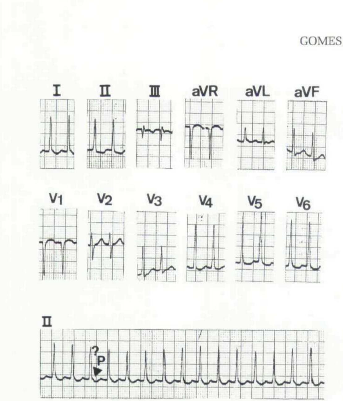 Figure 3 - Sinus Node Reentrant Tachycardia