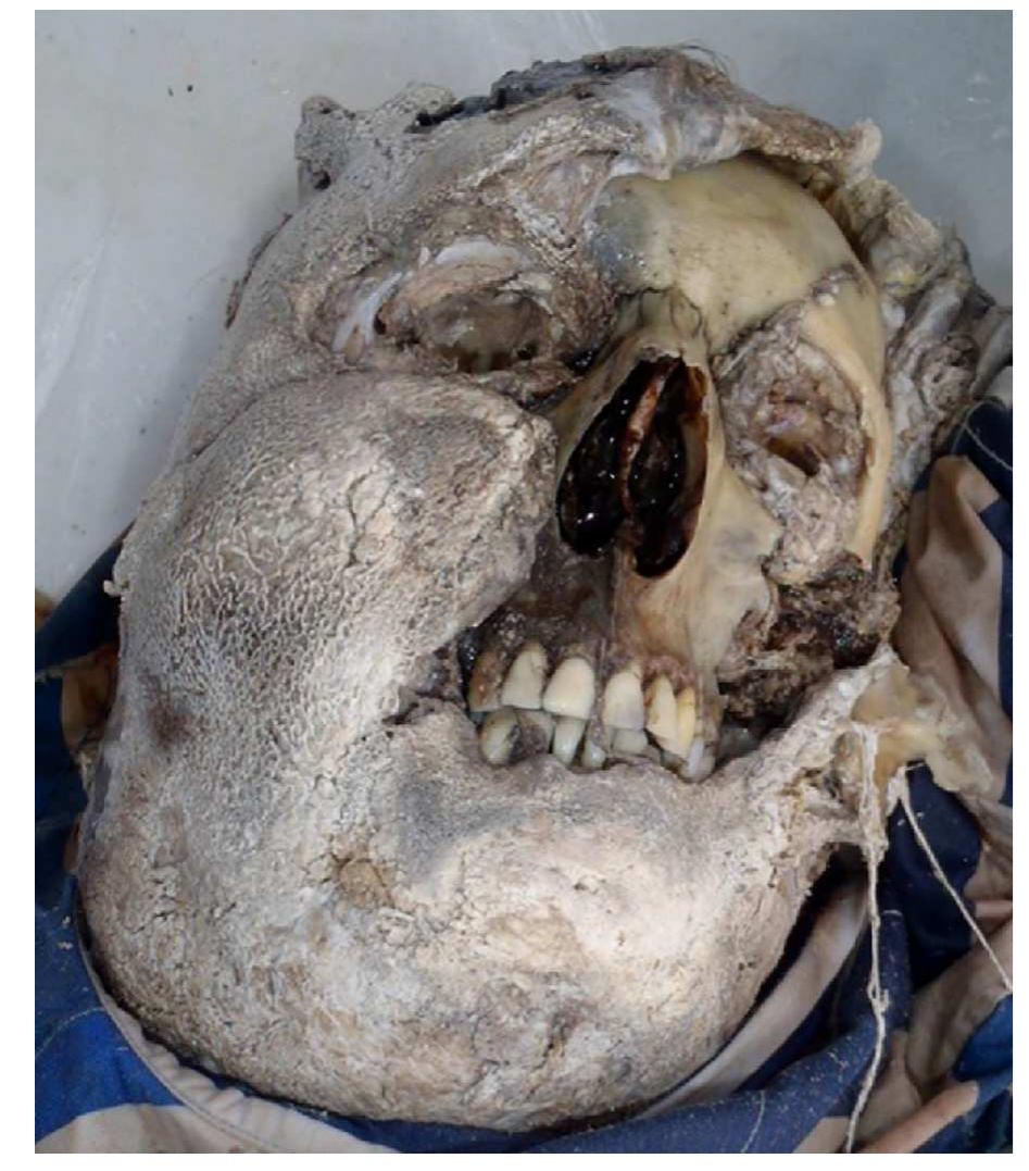 Adipocere formation.