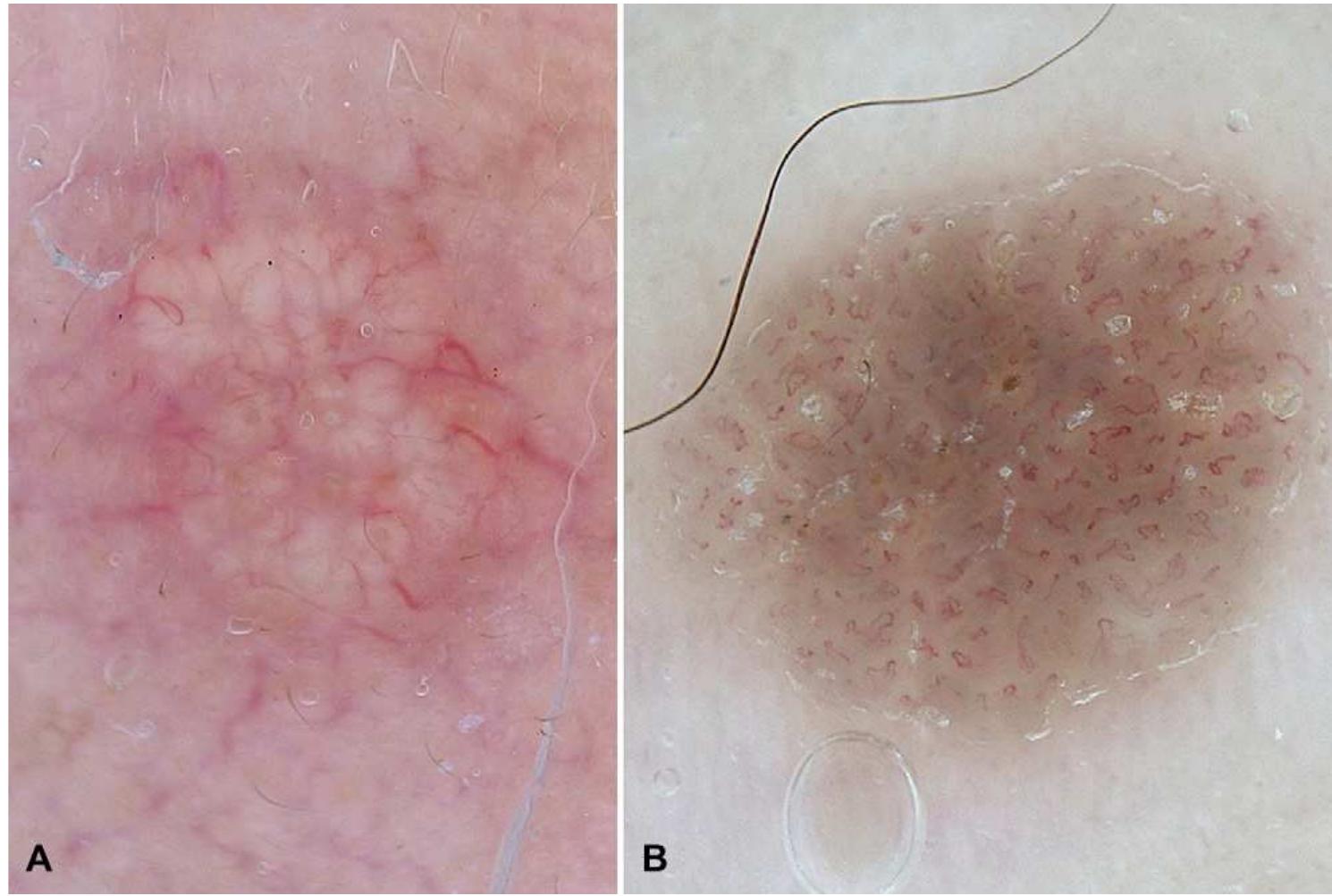 A, dermoscopy of sebaceous hyperplasia is typified by crown