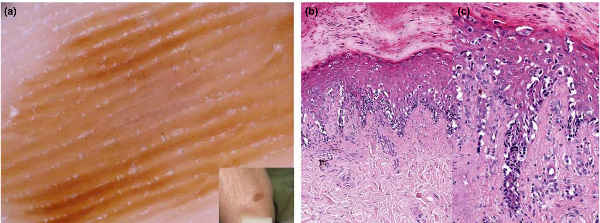 (a) dermoscopy of acral melanoma showing a parallel ridge