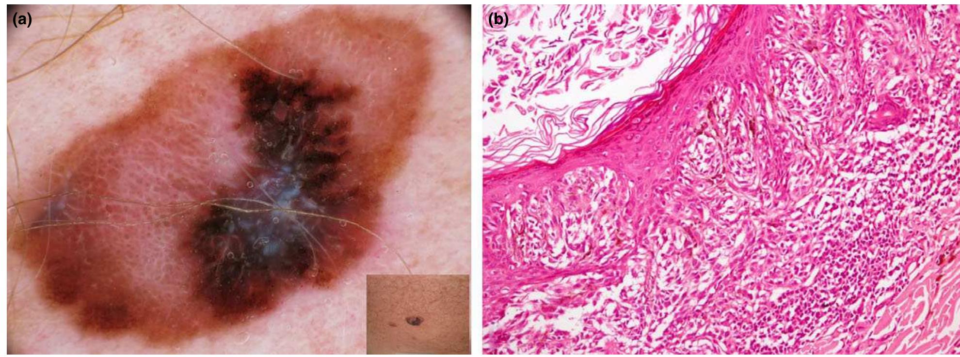 (a) dermoscopy of a clear-cut melanoma showing negative