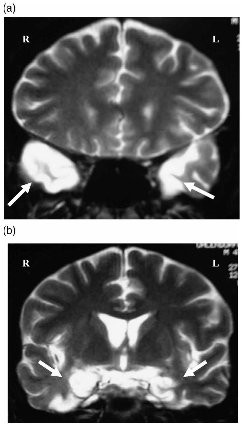 Lm’s mri scan showing the extent of the lesions involving