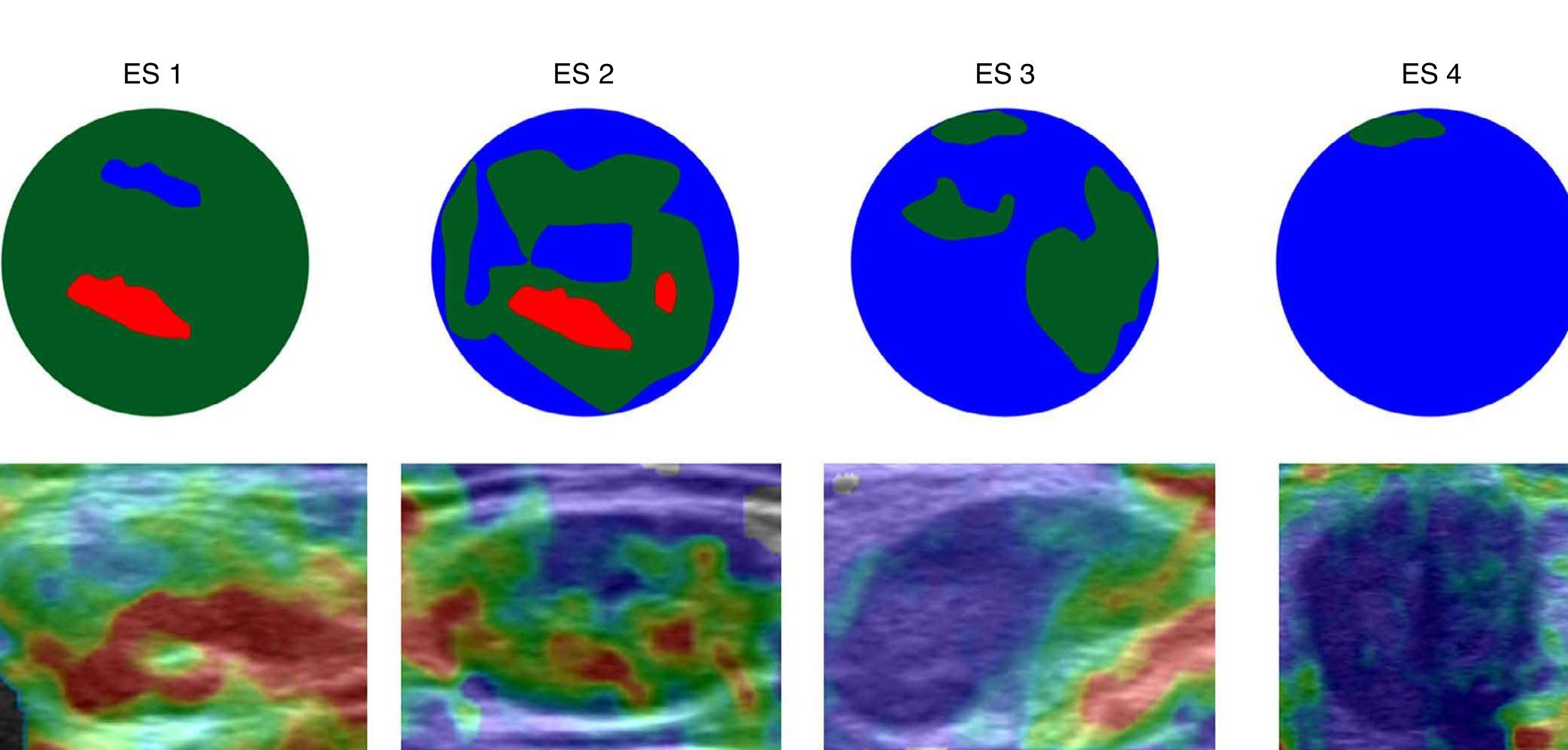 Elastographic scale (es) used to assess lymph nodes. es 1