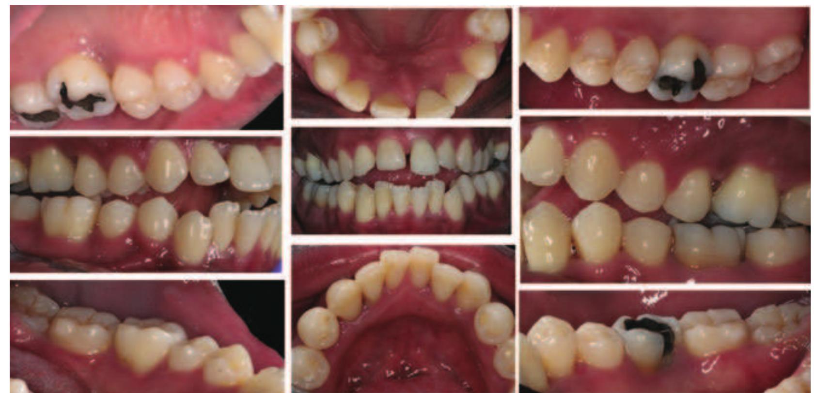 Figure 6 - from Aggressive periodontitis: case definition