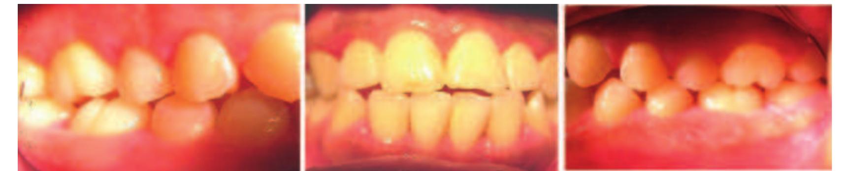 Figure 7 - from Aggressive periodontitis: case definition