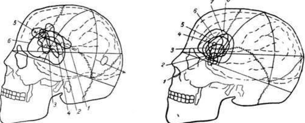 Schematic diagrams of lesions in cases of efferent motor