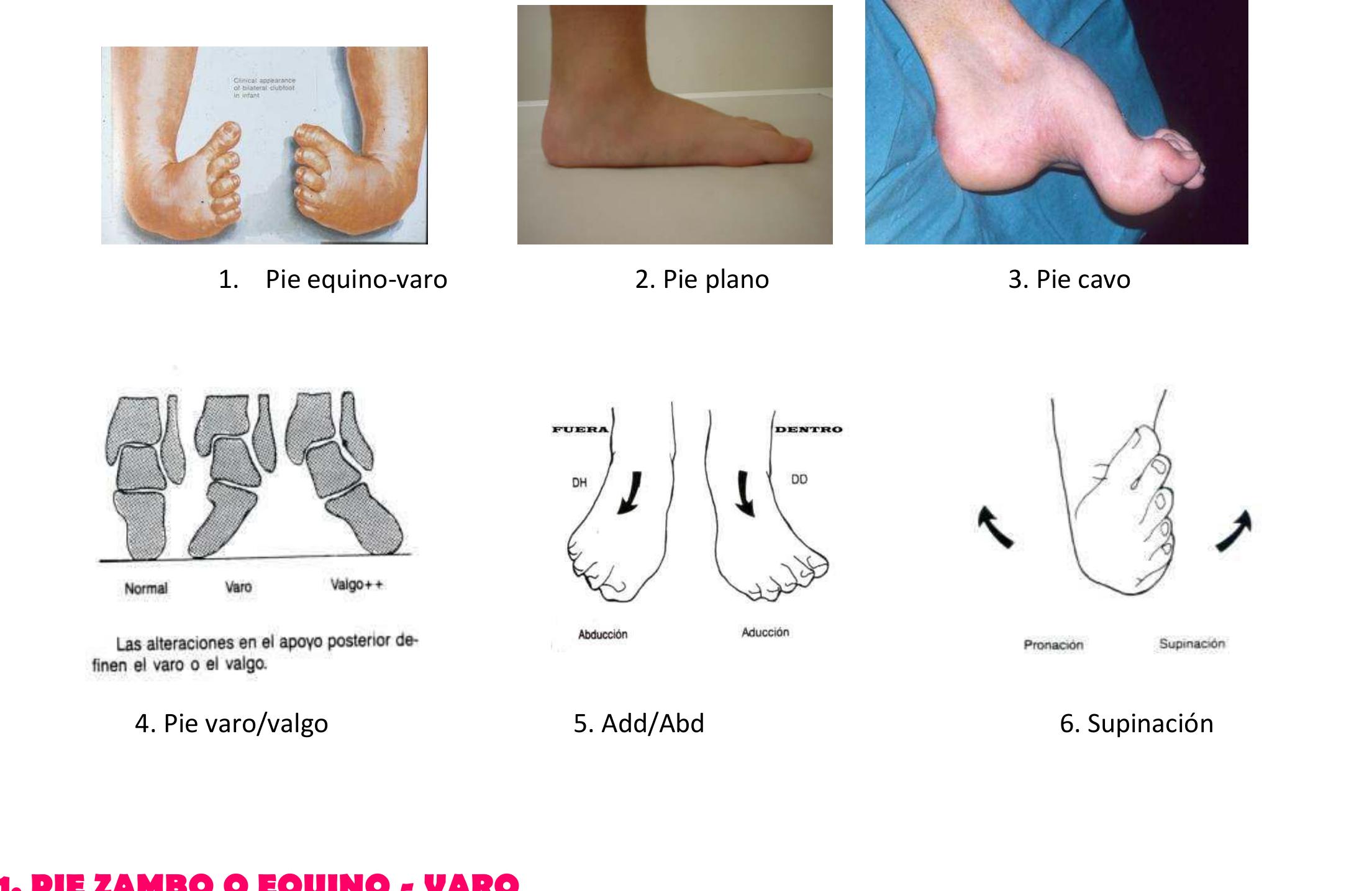 S la deformidad del pie mas frecuente, presente 1-1,5/1000
