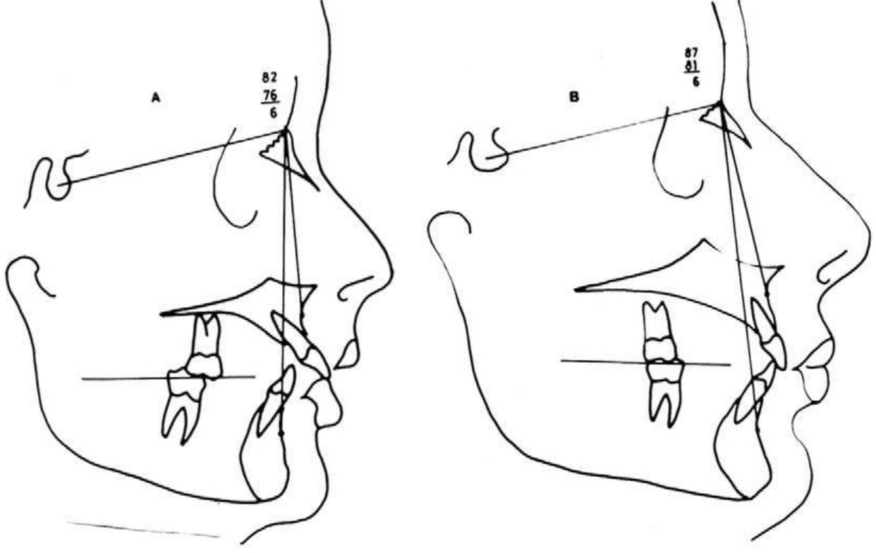 (PDF) The " Wits " appraisal of jaw disharmony