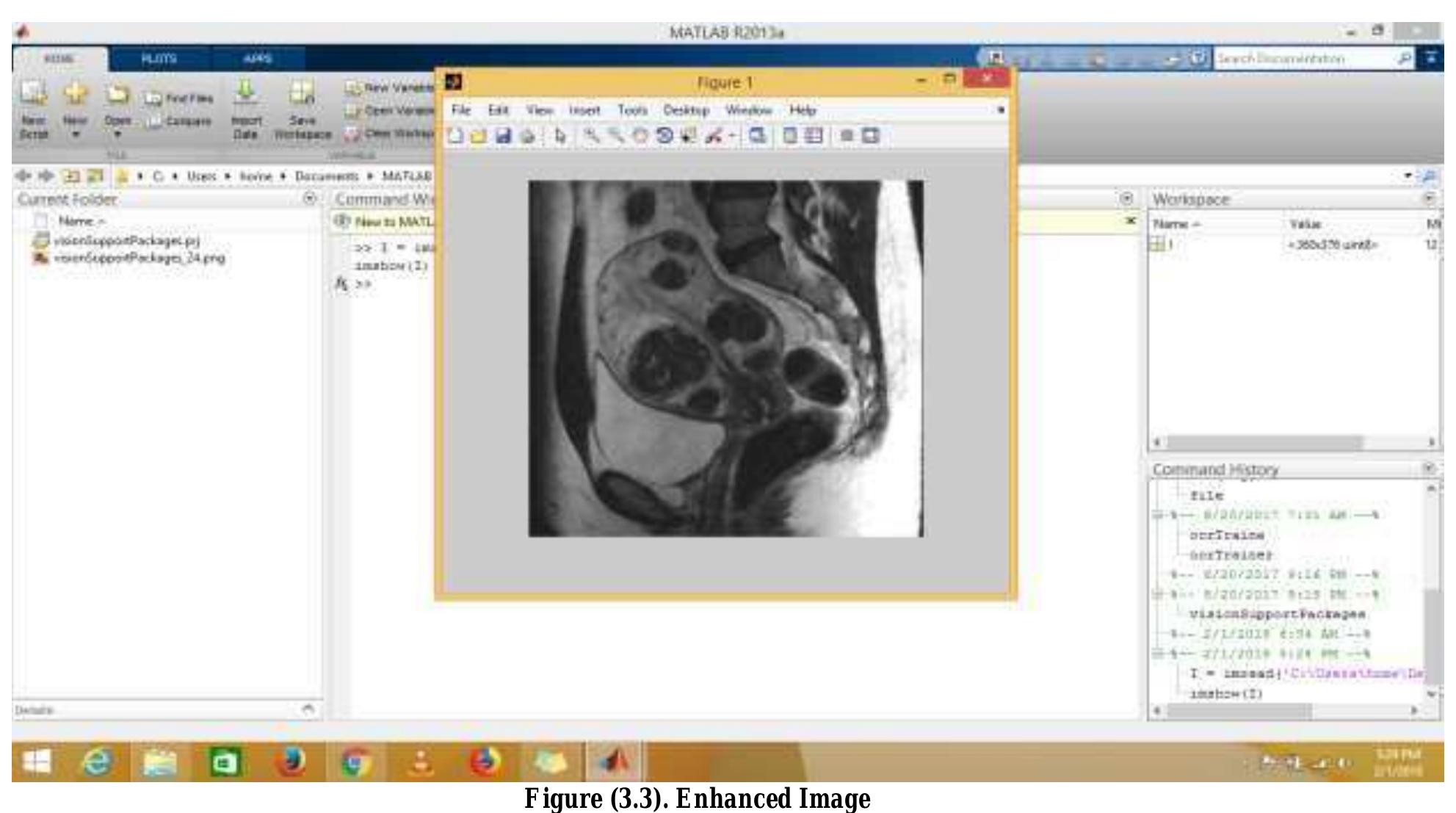 Figure 3 - COLORECTAL CANCER DETECTION IN MRI IMAGES USING