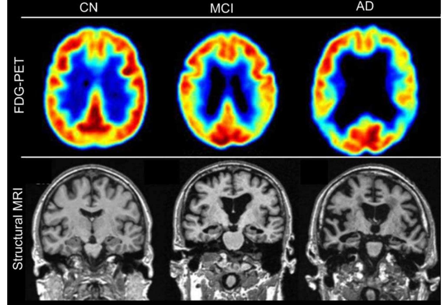 = theatrophy in ad and mci shown by structural mri scans,