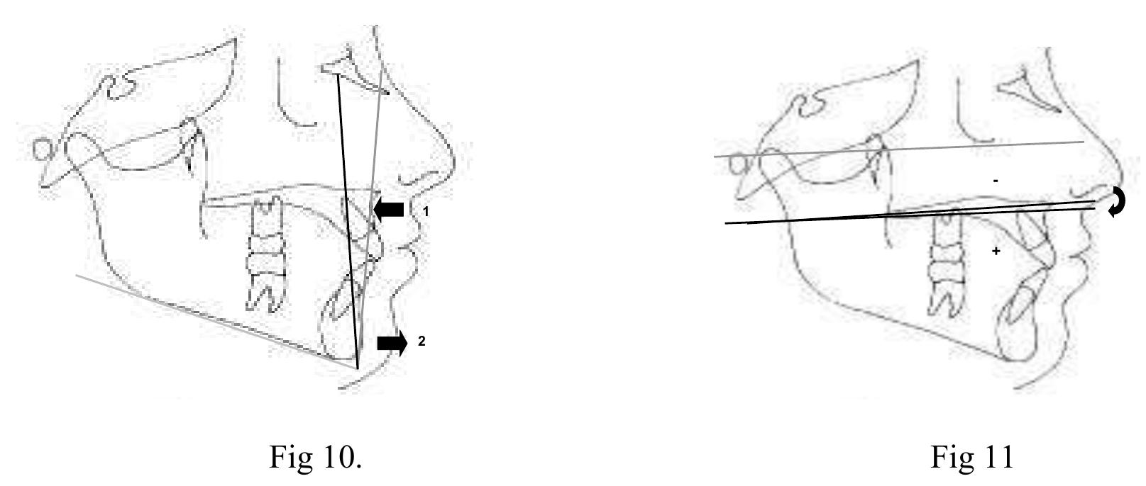 A-b plane closed: 1. maxillary retrusion. 2.mandibular