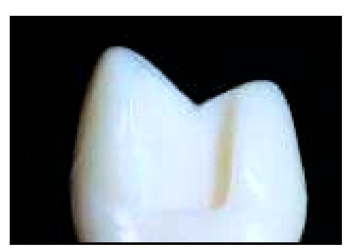 Proximal view of a2 abutment design on a maxillary right