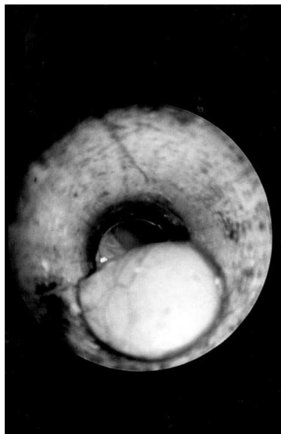 endoscopic view of maxillary sinus through a cannula