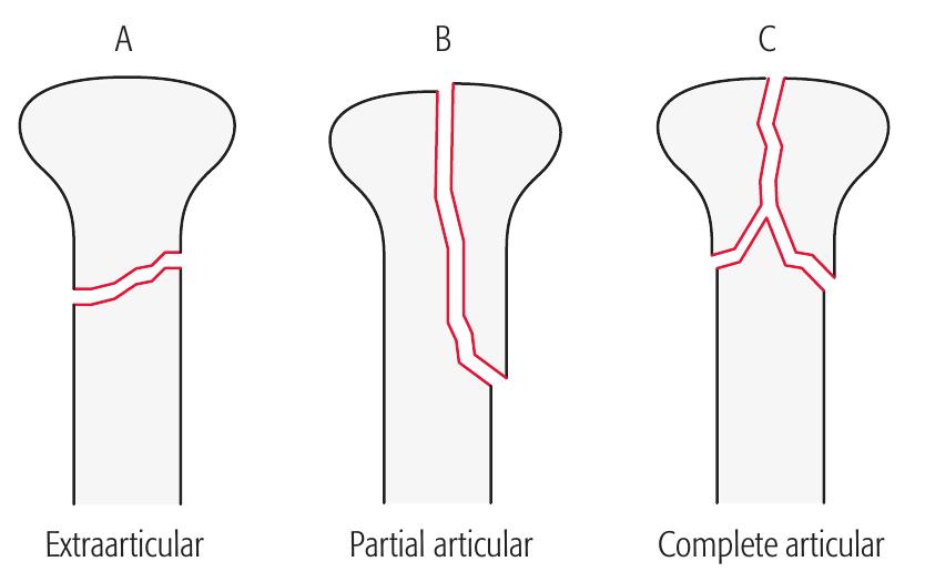 End segments fractures are divided into three types. further