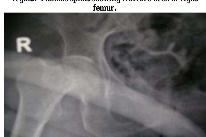 Figure 9 The Thomas Splint A Modification And Extension