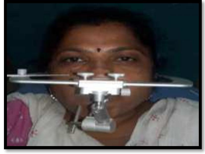 Figure 4 - FULL MOUTH REHABILITAION OF WORN DENTITION USING