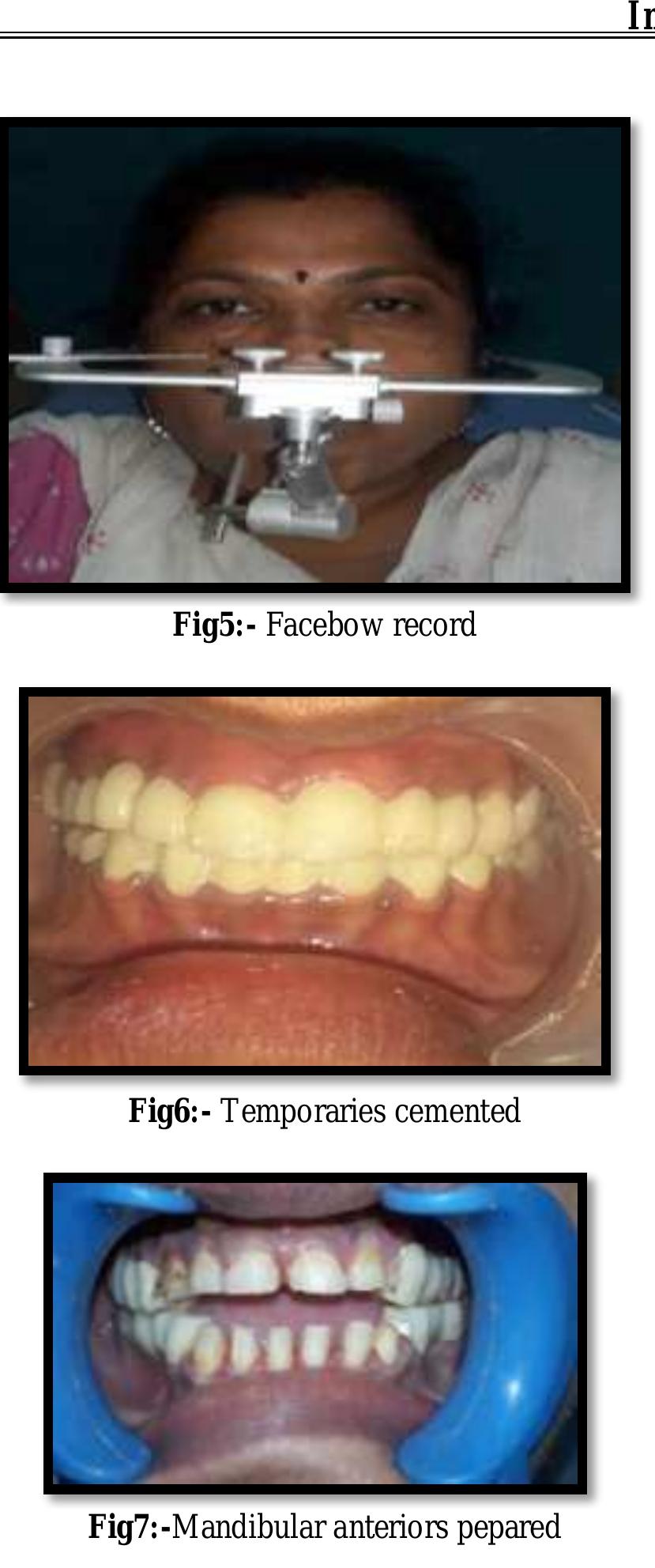 Figure 5 - FULL MOUTH REHABILITAION OF WORN DENTITION USING