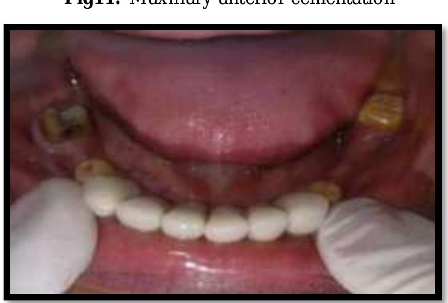 Figure 9 - FULL MOUTH REHABILITAION OF WORN DENTITION USING