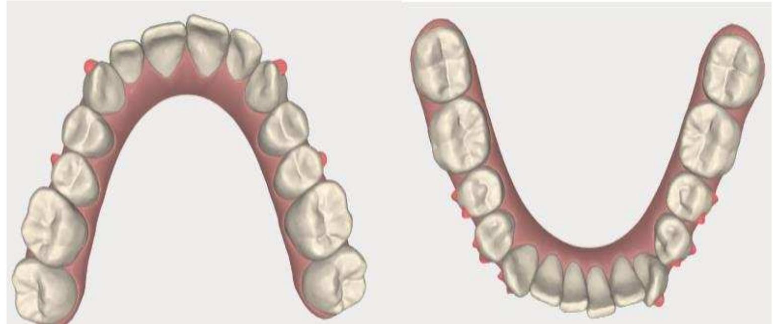 Attachmentes on upper and lower teeth. severe canine lower