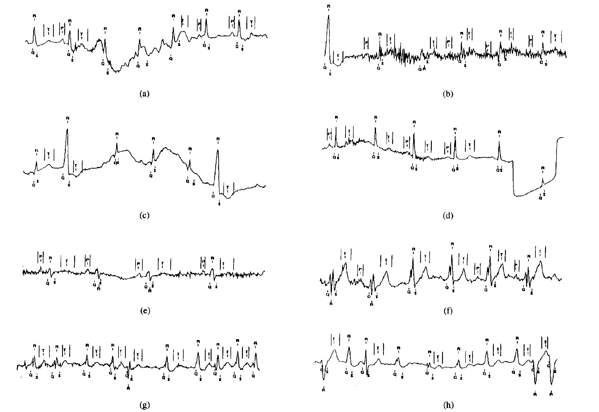 The detected ecg waves. the symbol r marks the locations of