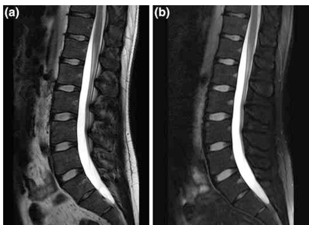Sagittal images of the lumbar spine. sagittal images of the