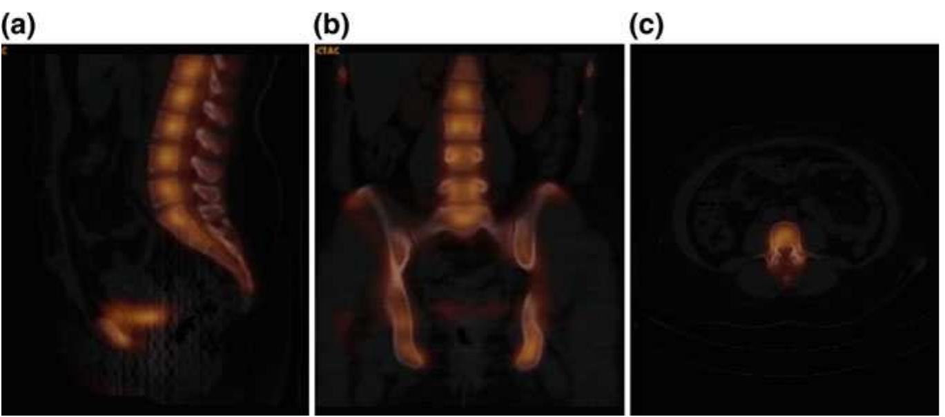 Spect/ct images of the spine. sagittal (a), coronal (b), and
