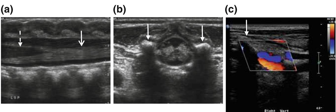Ultrasound images. ultrasound images of the spine. sagittal
