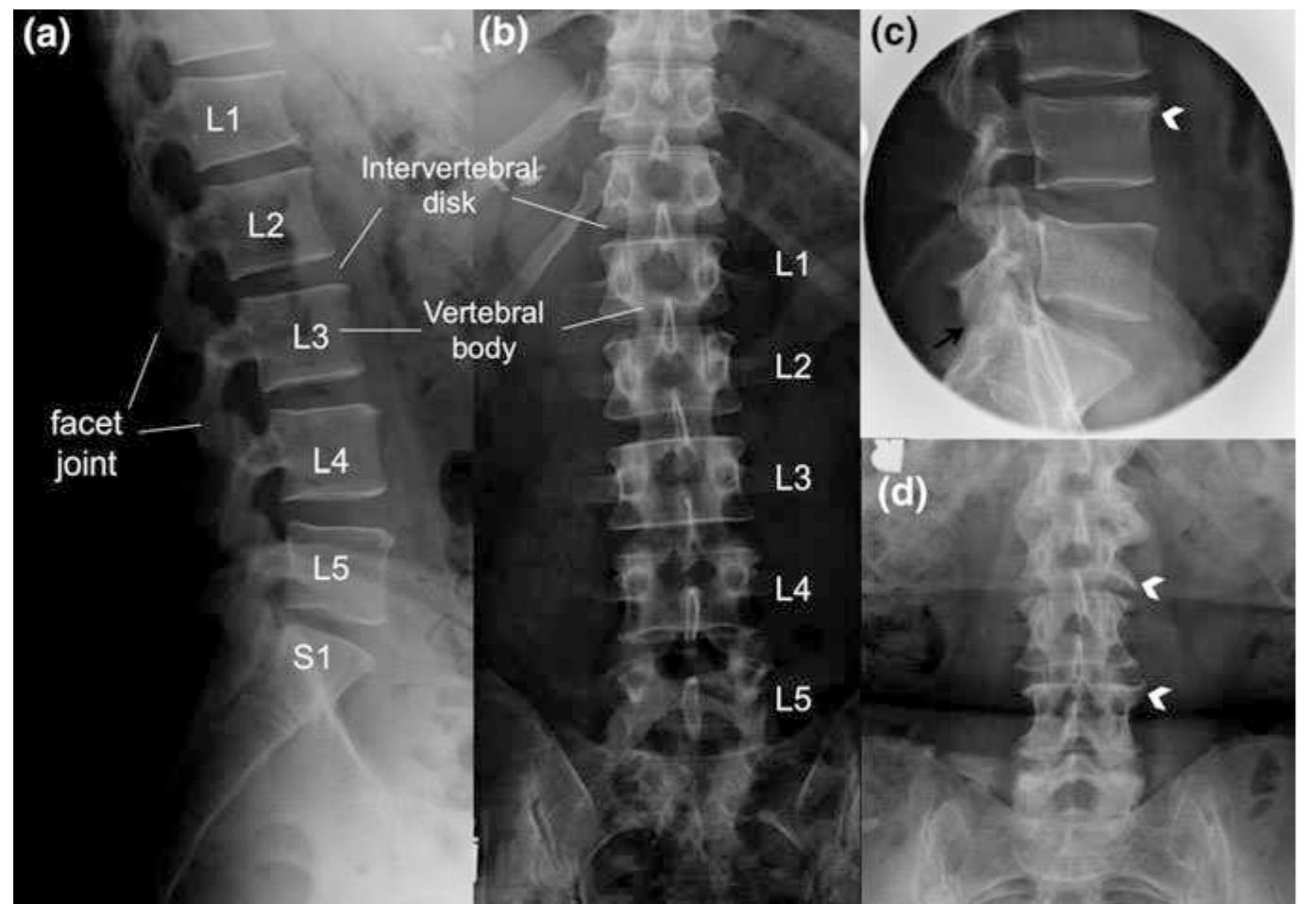 Plain radiograph of a normal lumbar spine and of lumbar