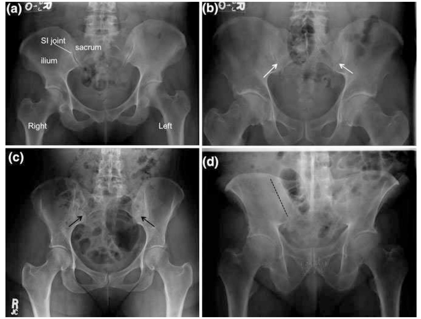 Radiographic grading of sacroiliac joint involvement in