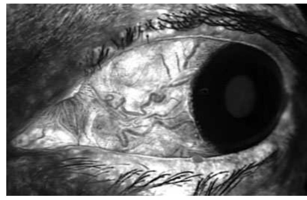 A. episcleral fluorescein angiography of the left eye (early