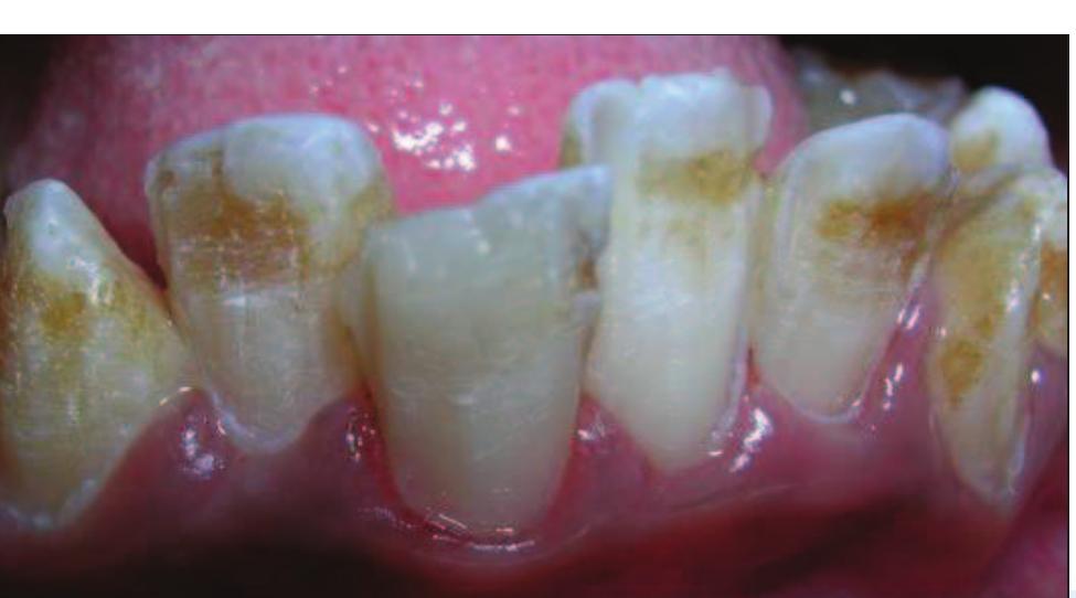 Preparation of the six mandibular anterior teeth by removing