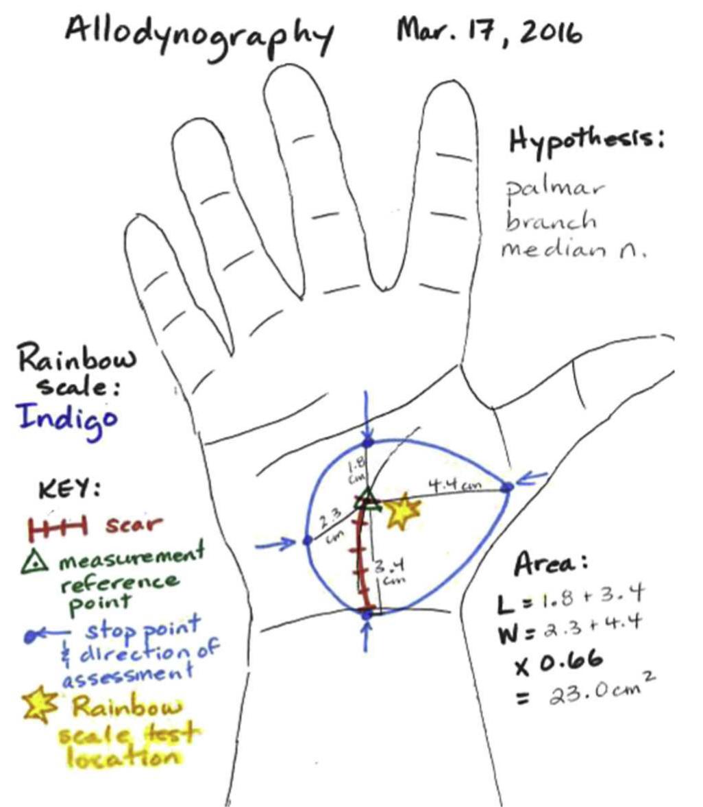 Sample allodynia map. (1) hypothesis designates the