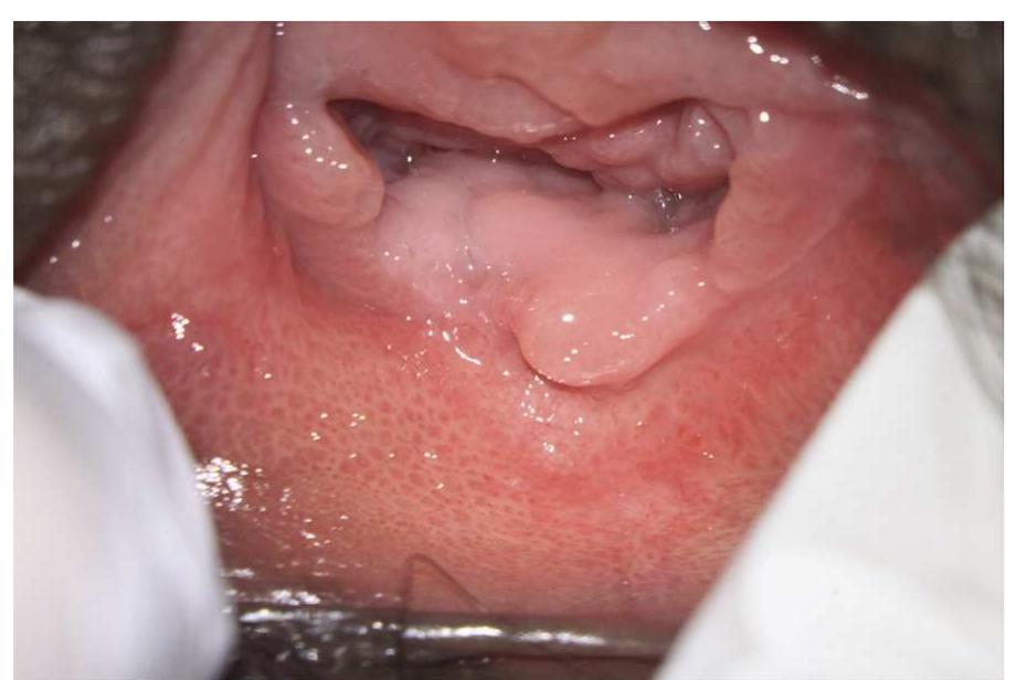 This photograph shows the vestibule, hymen, and fossa of an