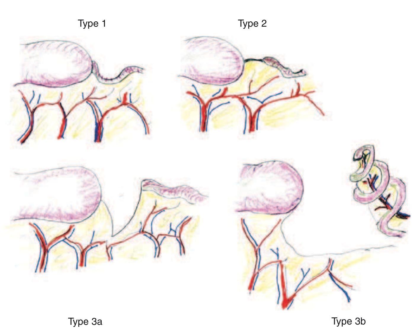 6.1 intestinal atresia classification — (types 1, 2, 3a, 3b,